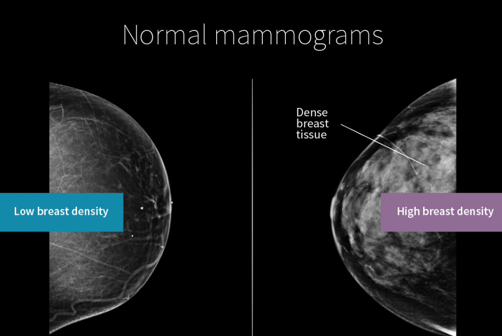 Mammogram breast density Wellend Health